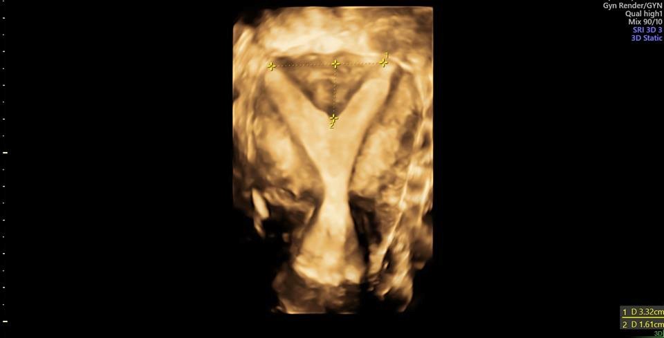 3D ultrasound in gynaecology | drtsoumpou.gr